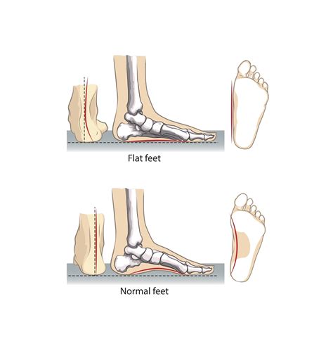 Flat Feet Sole For Flat Feet