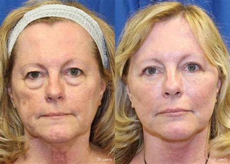Before And After Cleveland Plastic Surgery Institute
