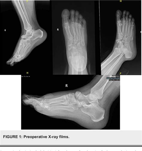 Figure 1 From The Management Of Navicular Dislocation And Multifocal Fractures Following A Fall