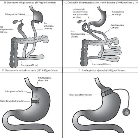 Historia de la cirugía bariátrica Download Scientific Diagram