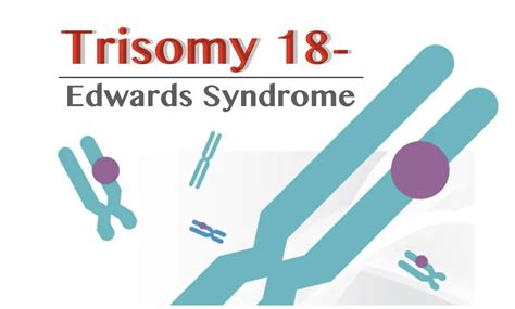 Edwards Syndrome Trisomy 18 Causes Symptoms And Types 1280x720