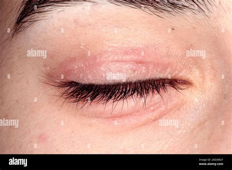 Eczema Around The Eye Close Up Of Dry Red Skin Around The Eye