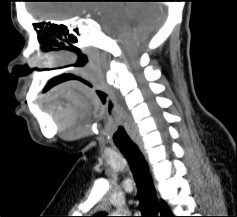 Calcific Tendinitis Of The Longus Colli Muscle Pacs