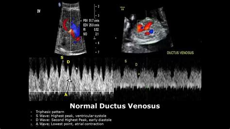Fetal Ductus Venosus Doppler Ultrasound Normal Vs Abnormal Image