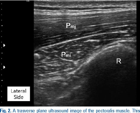 Figure 3 From Application Of Ultrasound Guided Trigger Point Injection For Myofascial Trigger