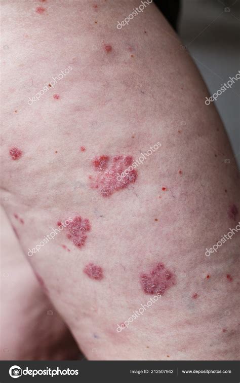 Close Up Ill Allergic Rash Eczema Skin Of Patient Atopic Dermatitis