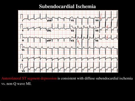 PPT Electrocardiography PowerPoint Presentation Free Download ID