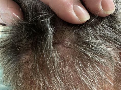 On Scalp Dry Painful Itchy Pustules Rdermatology