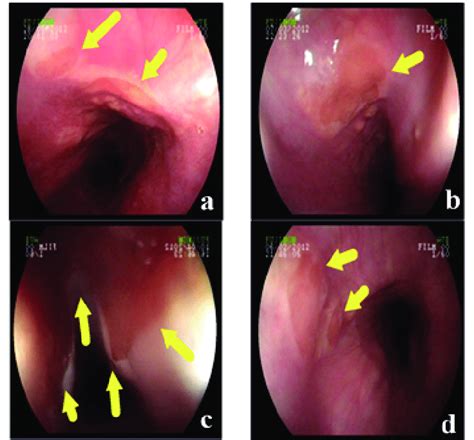 A Two Different Inlet Patch Zone 14 Cm Distal From The Incisors B