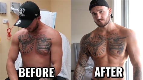 Gynecomastia Before And After Exercise