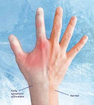 First Degree Frostbite