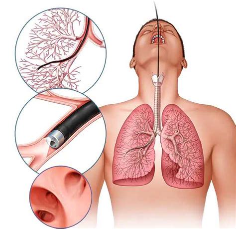 Lung Cancer Treatment Aastha Oncology Associates