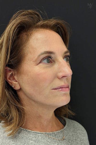 Neck Lift Before And After Photos Dr Mark Fisher