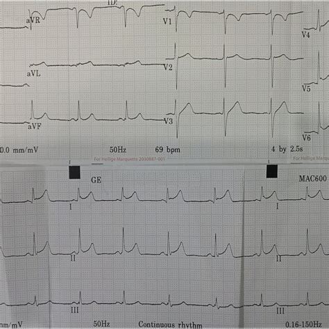 Ecg Showing T Inversion In Avr And V1 With St Elevation In Other Leads Download Scientific