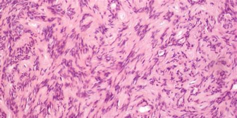 Tumor de glándula mamaria izquierda Sociedad Latinoamericana de Patología