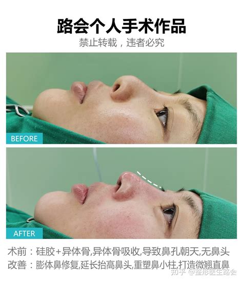 朝天鼻是不是最丑的鼻型？ 知乎