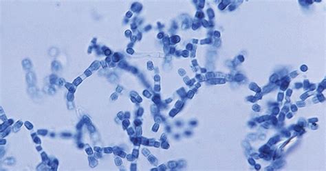 Coccidioidomycosis An Overview