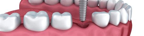 Root Canal Vs Implant Which Is Best The Smile Makeover