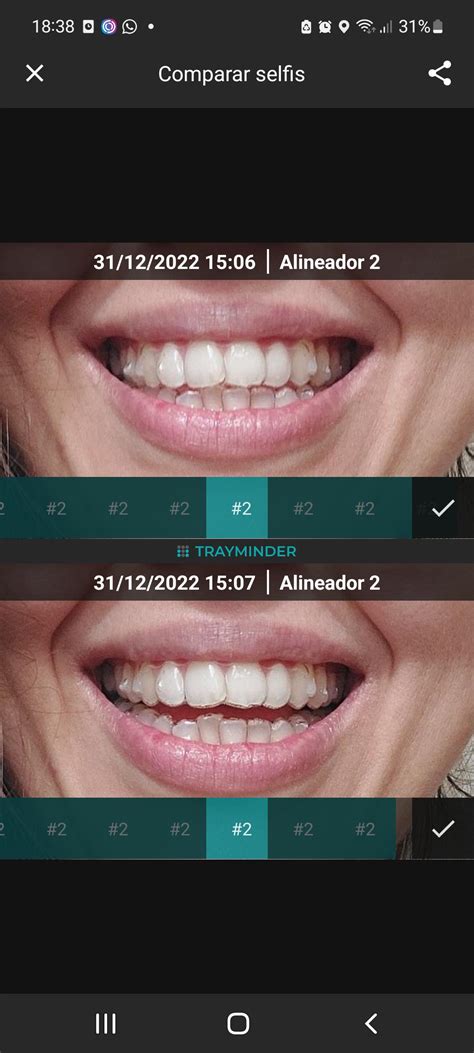 Are They Pushed Enough In Chewies R Invisalign