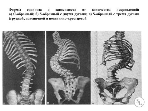 Что такое S образный сколиоз