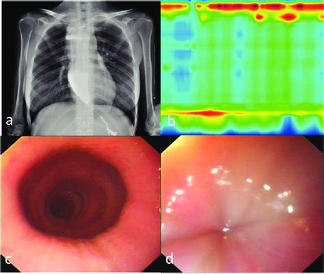 The Diagnostic Evidence In A 21 Year Old Woman That Presented With A