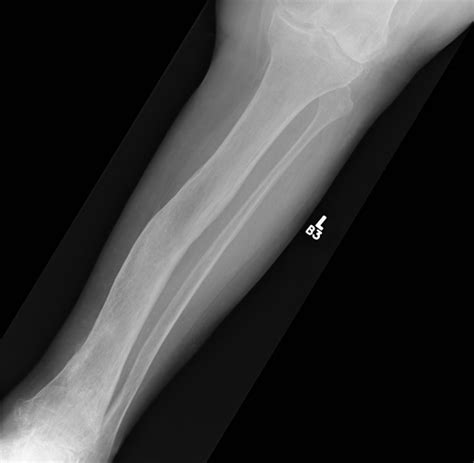 Pagets Disease Of Bone Physiopedia At Robert Hambright Blog