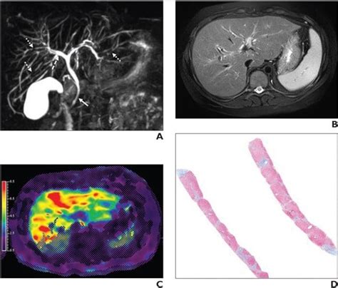 Mri Shows Promise In Liver Fibrosis Detection Axis Imaging News