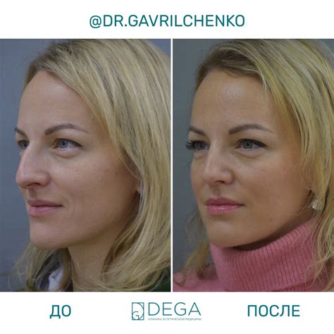 Как пластика носа меняет внешность Клиника эстетической медицины