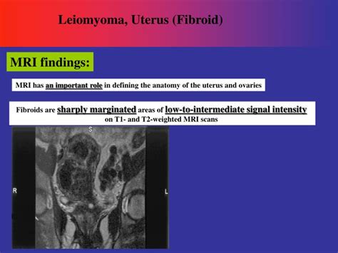 Ppt Leiomyoma Uterus Fibroid Powerpoint Presentation Id862850