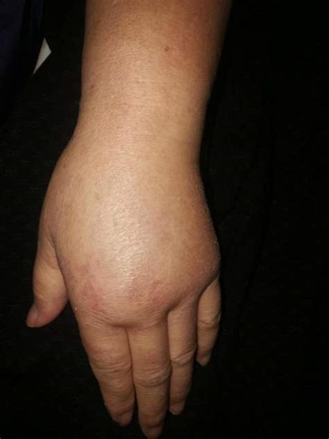 中山医院皮肤科发现一种特殊类型的皮肌炎!出现这些症状要警惕腾讯新闻 中山医院皮肤科发现一种特殊类型的皮肌炎!出现这些症状要警惕腾讯新闻