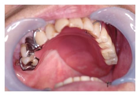 After Placement Of A Denture For A Defective Maxilla Download