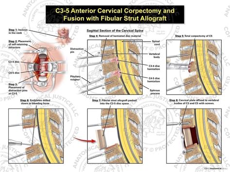 C3 4 Anterior Cervical Discectomy And Artificial Disc Placement