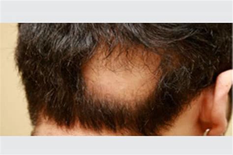 Dr Al Rustom Polyclinic Alopeica Areata