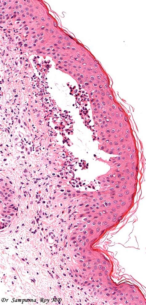 Pin On Dermatopathology Posts Articles Illustrations And Quiz Cases
