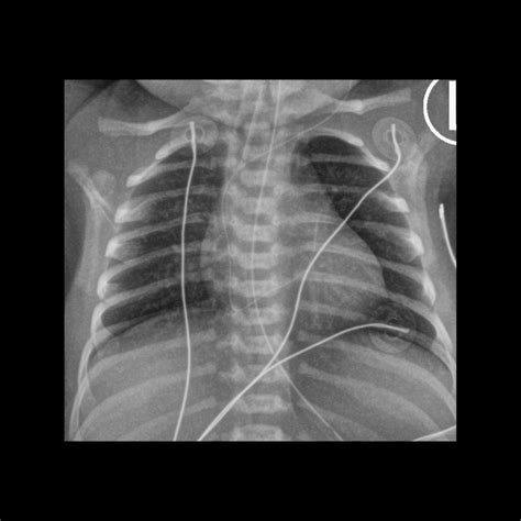 Premature Newborn After Picc Placement Pediatric Radiology Case