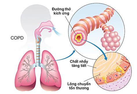 Kế hoạch chăm sóc bệnh nhân COPD chuẩn đầy đủ nhất 2024