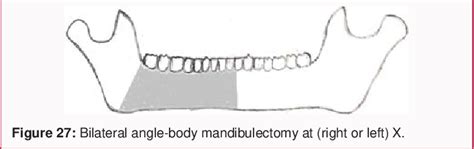 Figure 4 From Classification Of Mandibulectomy Mandibular Defects