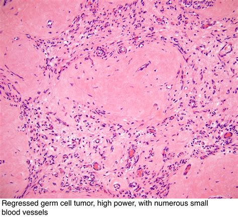 Pathology Outlines Regressed Germ Cell Tumor