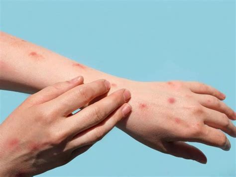 Vaiolo Delle Scimmie 11 Casi Nellarea Di Firenze Cosa Sappiamo