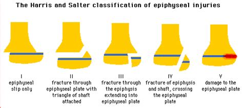 Salter Harris Classification Diagram Gpnotebook