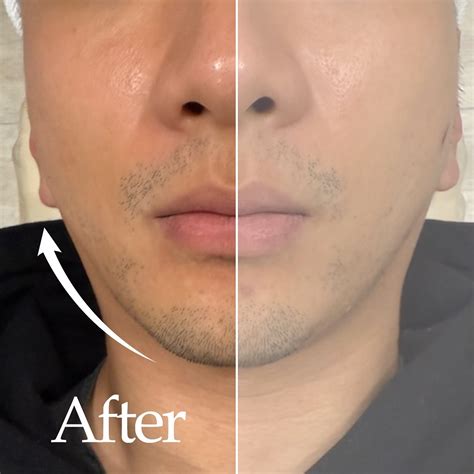 지우클리닉ㅣ강남역피부과ㅣ리프팅 색소치료 여드름흉터 스킨부스터 팔자주름 리쥬란 인모드 쥬브젠 이래비티 리프팅 강남피부과 리프팅 🌟 重力を逃れたリフティング、痛く