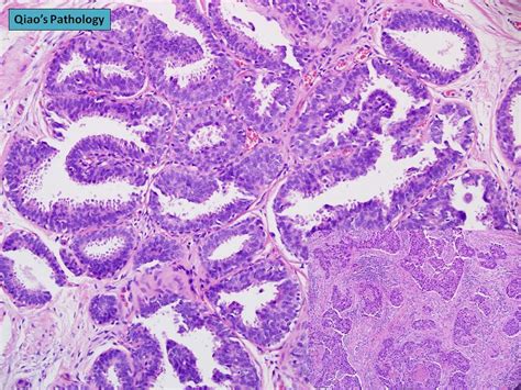 What Is Columnar Cell Hyperplasia At Louis Mitchell Blog