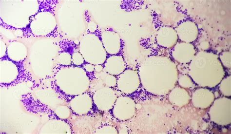 Photomicrograph Bone Marrow Study Megakaryocytic Hyperplasia 45477930