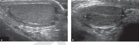 Figure 1 From Normative Values For Testicular Volume Measured By