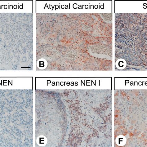 Representative Staining Patterns Obtained In Bronchopulmonary Ac And