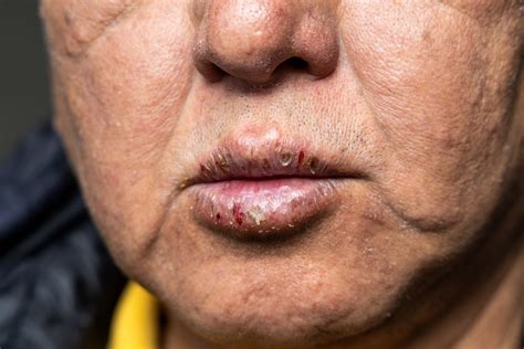 Queilitis Angular Causas Y Tratamiento Efectivo