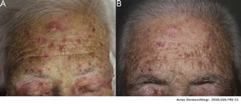 Actinic Elastosis Treatment
