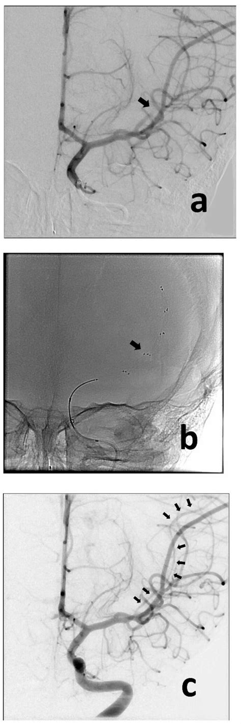Anteroposterior Angiographic And Fluoroscopic Views Of The Thrombectomy Download Scientific