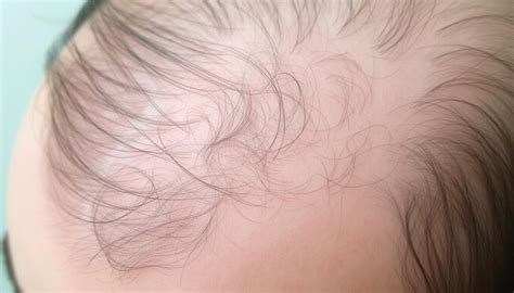 Burning Scalp And Hair Loss Whats The Connection