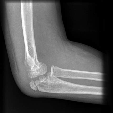 Xray Elbow